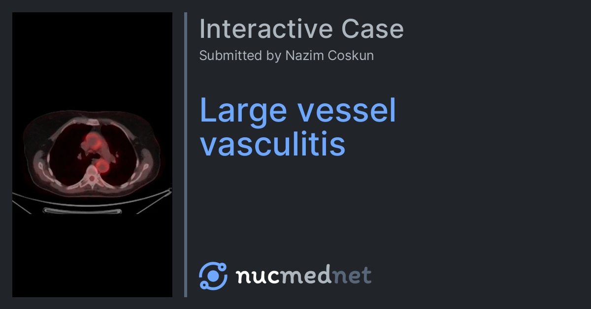 Large Vessel Vasculitis Nucmed Net